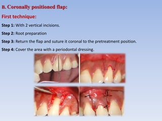 Mucogingival surgery | PDF