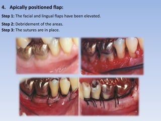 Mucogingival surgery | PDF | Dental Health | Diseases and Conditions