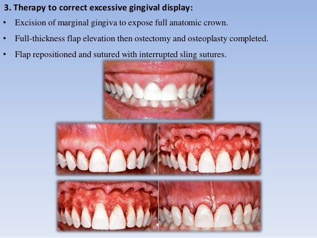 Mucogingival surgery