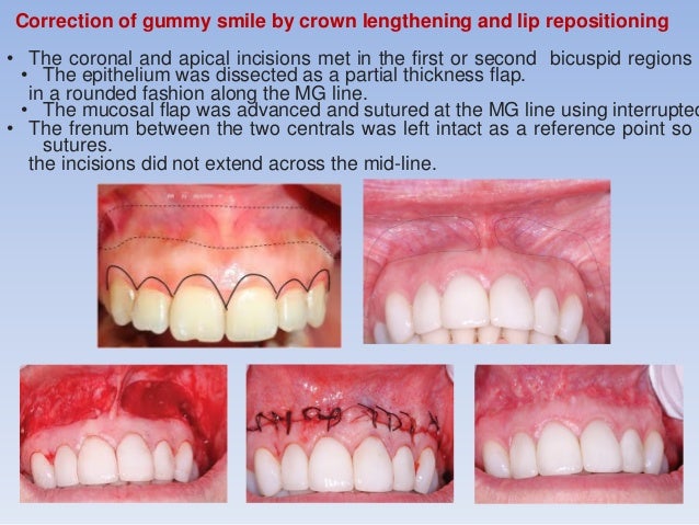Mucogingival surgery