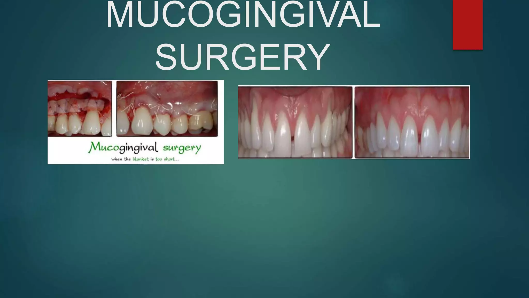 Mucogingival surgery in periodontics | PPTX