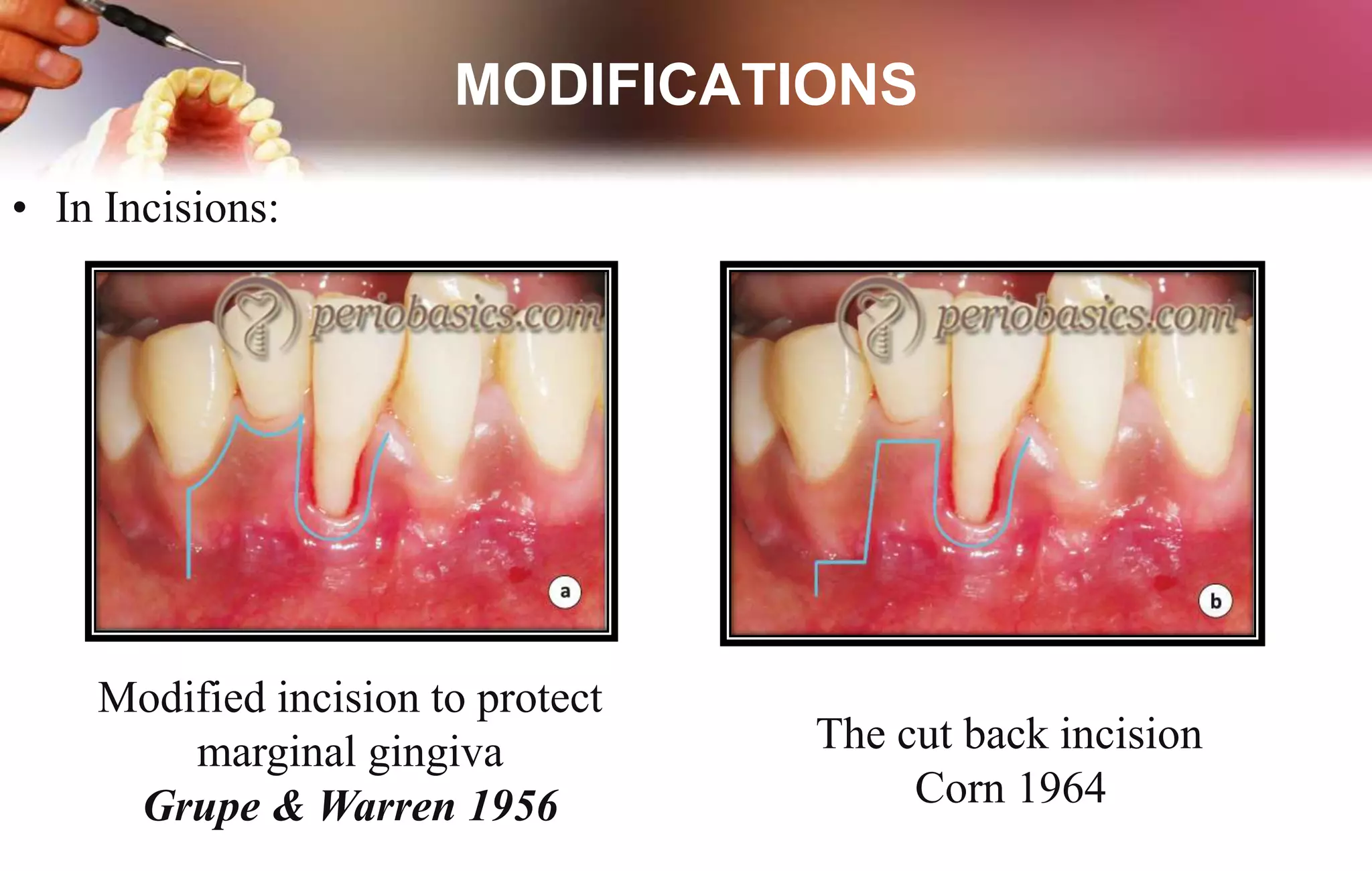 MUCOGINGIVAL SURGERY.pptx
