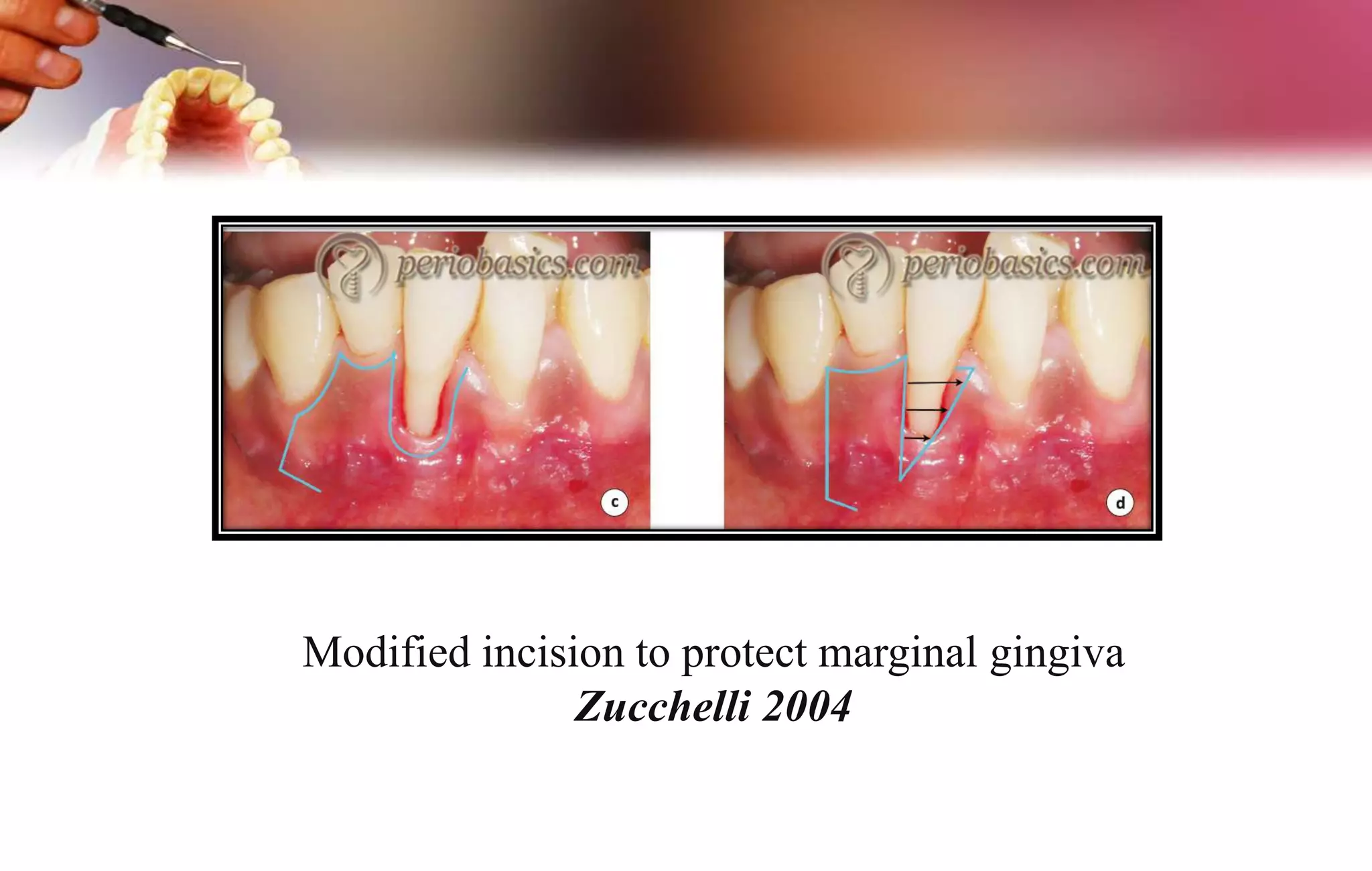 MUCOGINGIVAL SURGERY.pptx