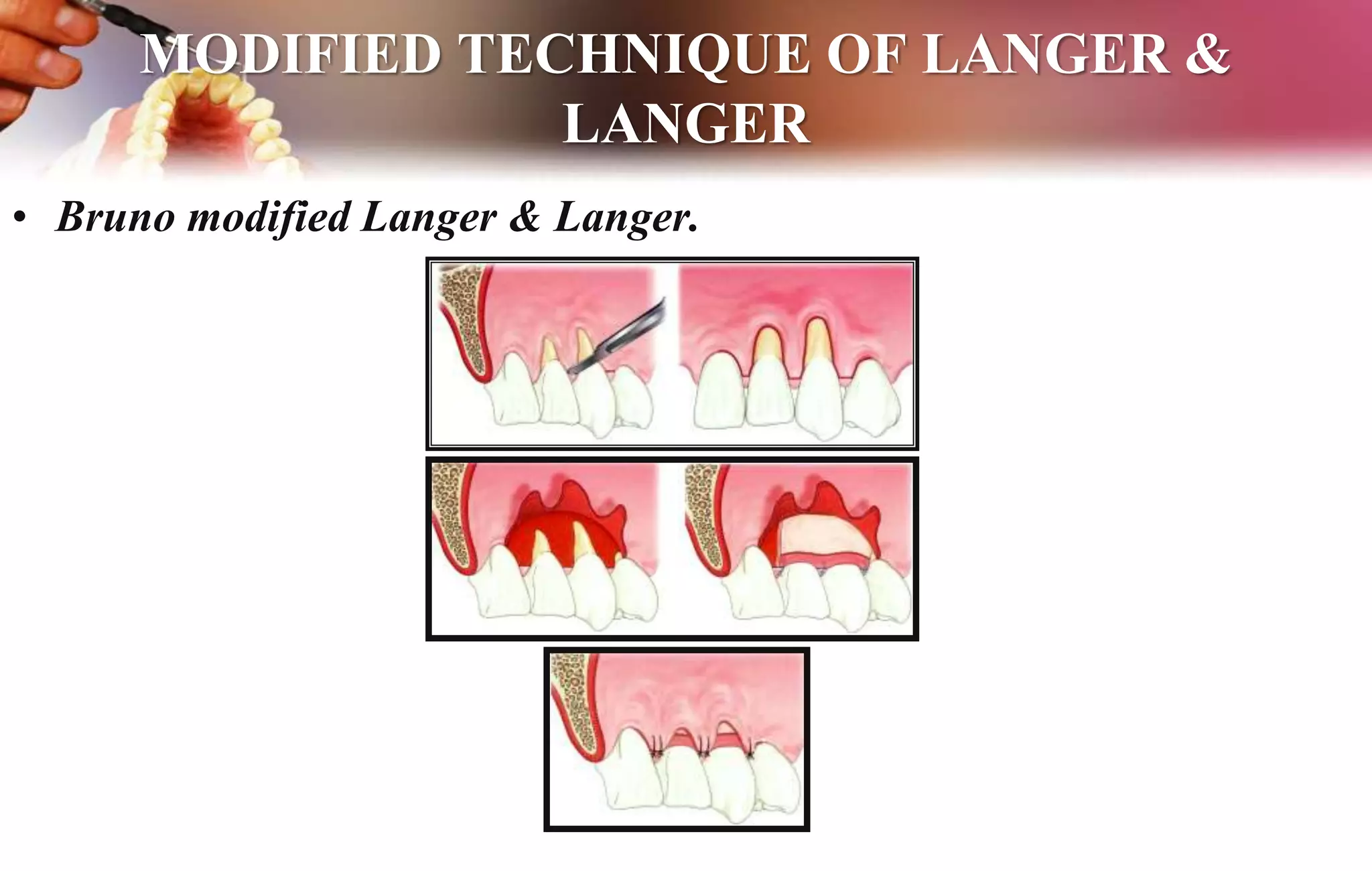 MUCOGINGIVAL SURGERY.pptx