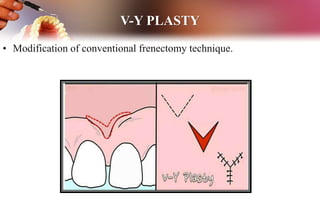MUCOGINGIVAL SURGERY.pptx