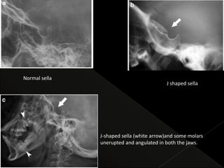 radiological features of Mucopolysaccharidoses | PPTX