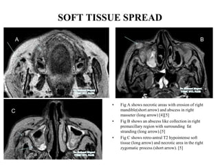 MRI of cranio-facial mucormycosis | PPTX