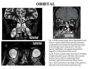 MRI of cranio-facial mucormycosis | PPTX