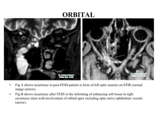 MRI of cranio-facial mucormycosis | PPTX