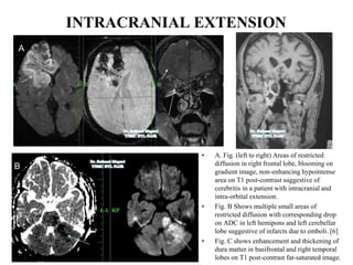 MRI of cranio-facial mucormycosis | PPTX