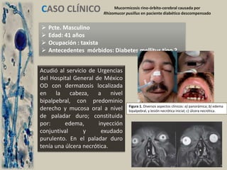 Mucormicosis | PPTX