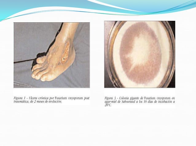 Mucormicosis (cigomicosis) luis r. | PPT