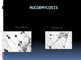 Mucormycosis | PPTX