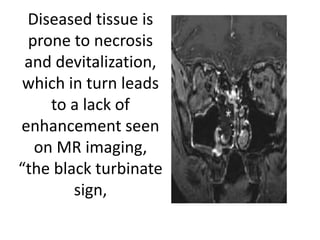 Mucormycosis | PPT