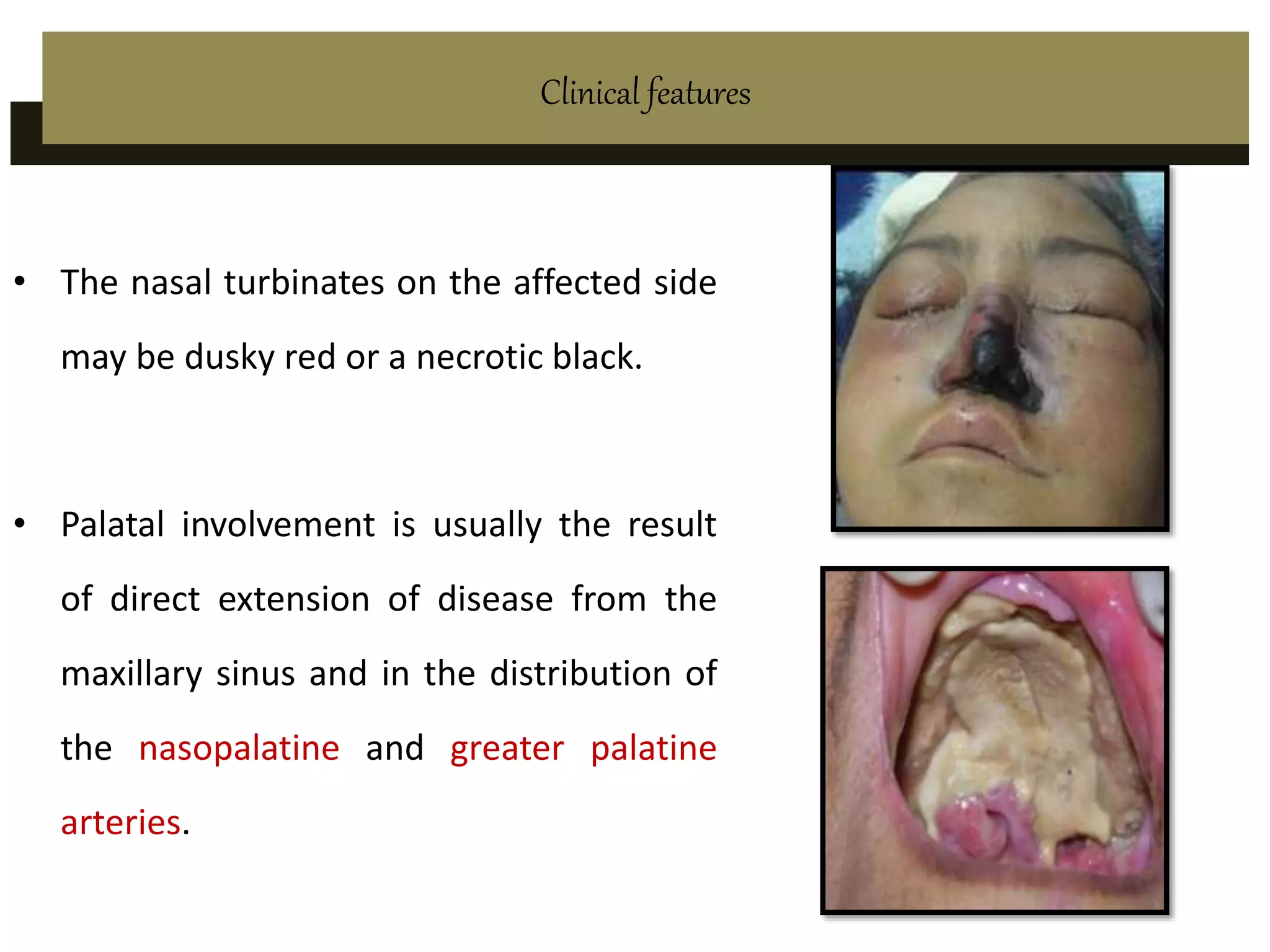 Mucormycosis in head and neck region | PPTX | Ear, Nose and Throat ...