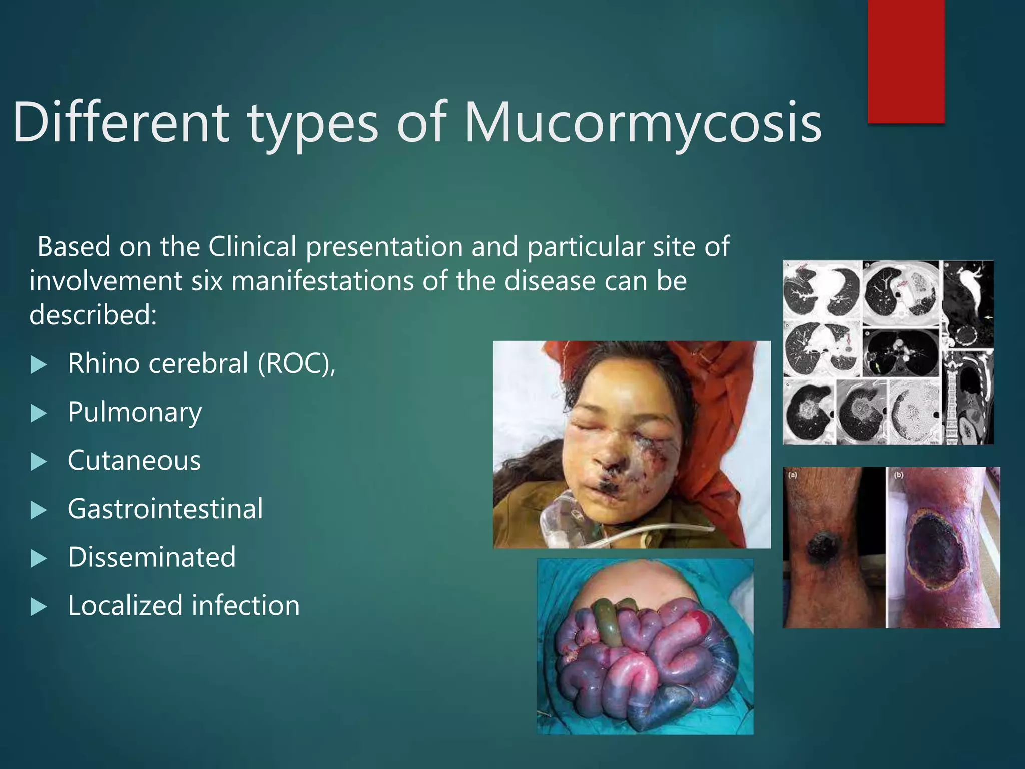 Mucormycosis | PPTX