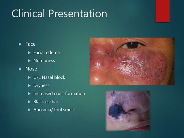 Mucormycosis | PPTX | Lung and Respiratory Health | Diseases and Conditions