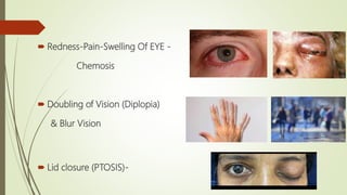 Mucor mycosis | PPTX