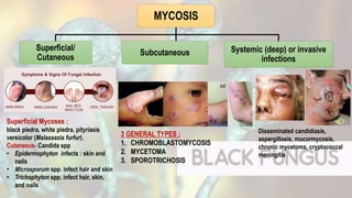 Mucormycosis | PPTX