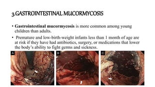 MUCORMYCOSIS.pptx