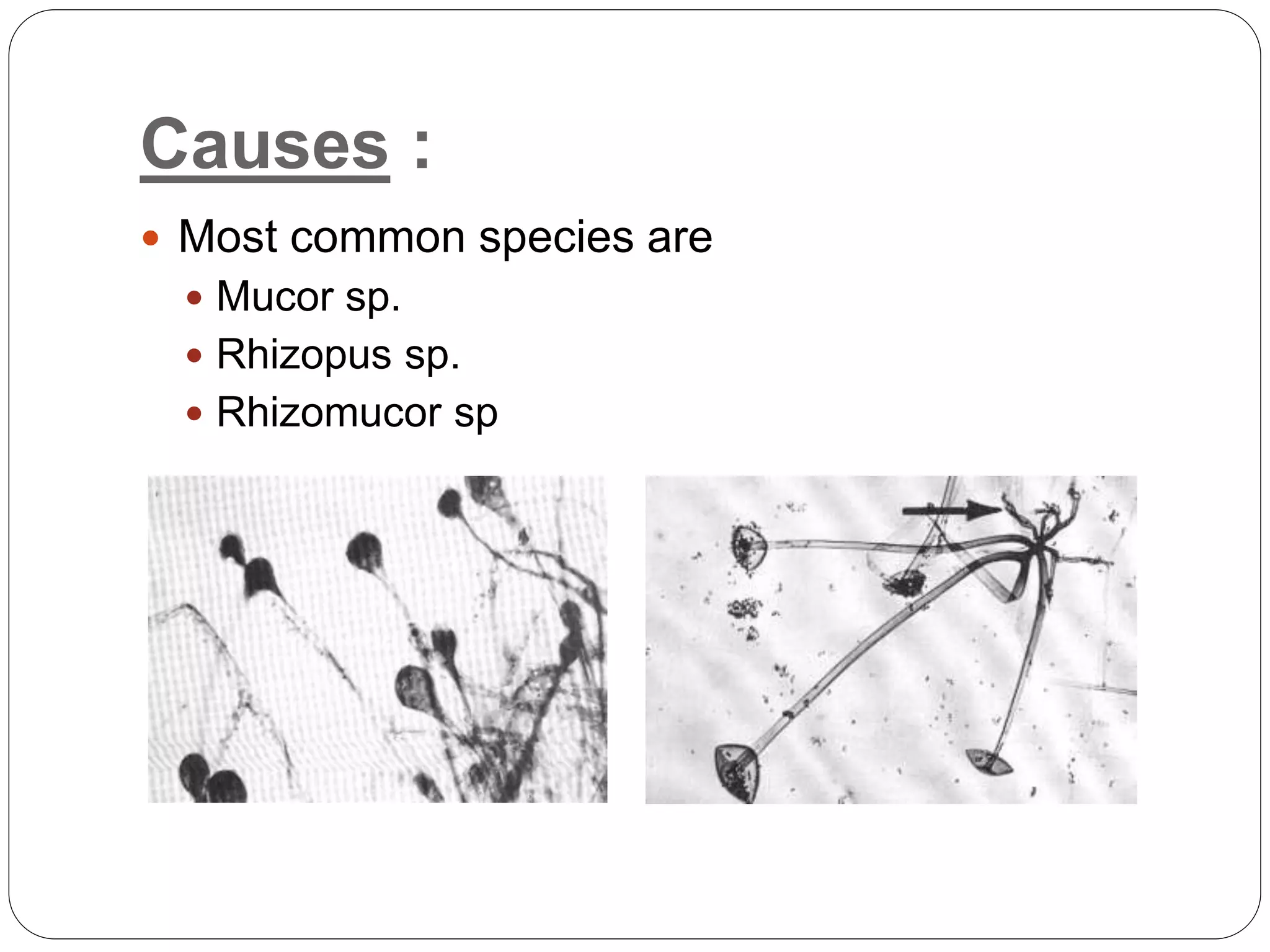 Mucormycosis - Orientation.pptx