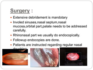 Mucormycosis - Orientation.pptx