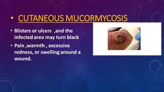 Mucormycosis (Black fungus) | PPT