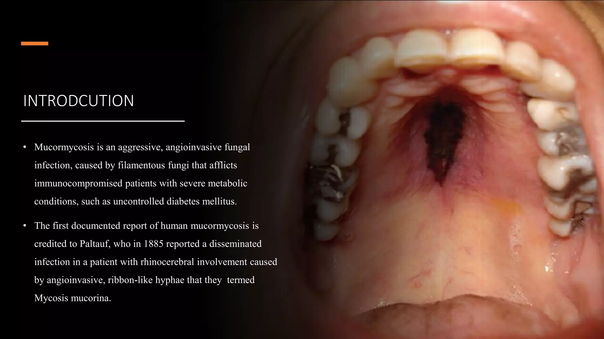 Mucormycosis and its management | PPTX