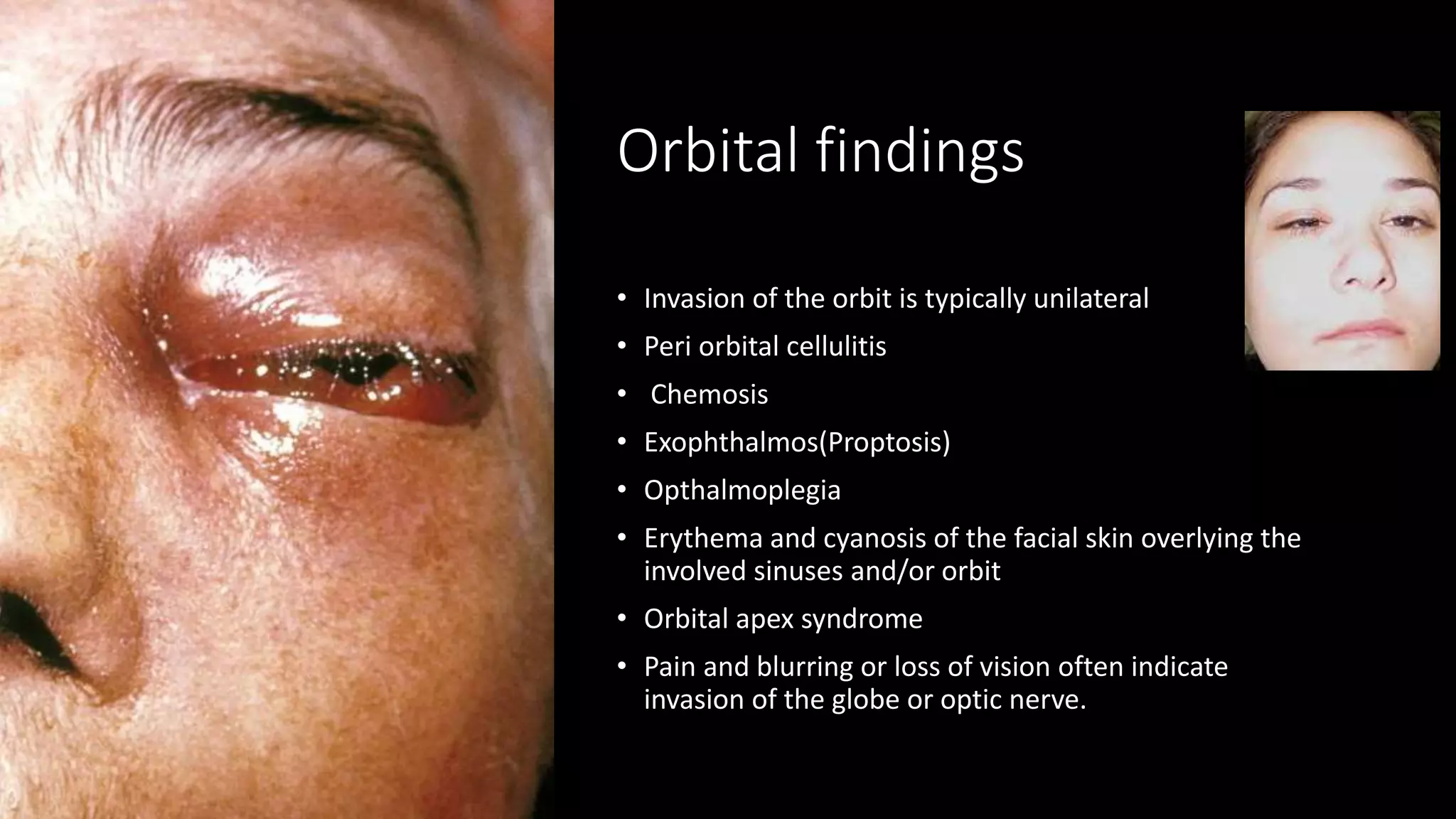 Mucormycosis and its management | PPTX