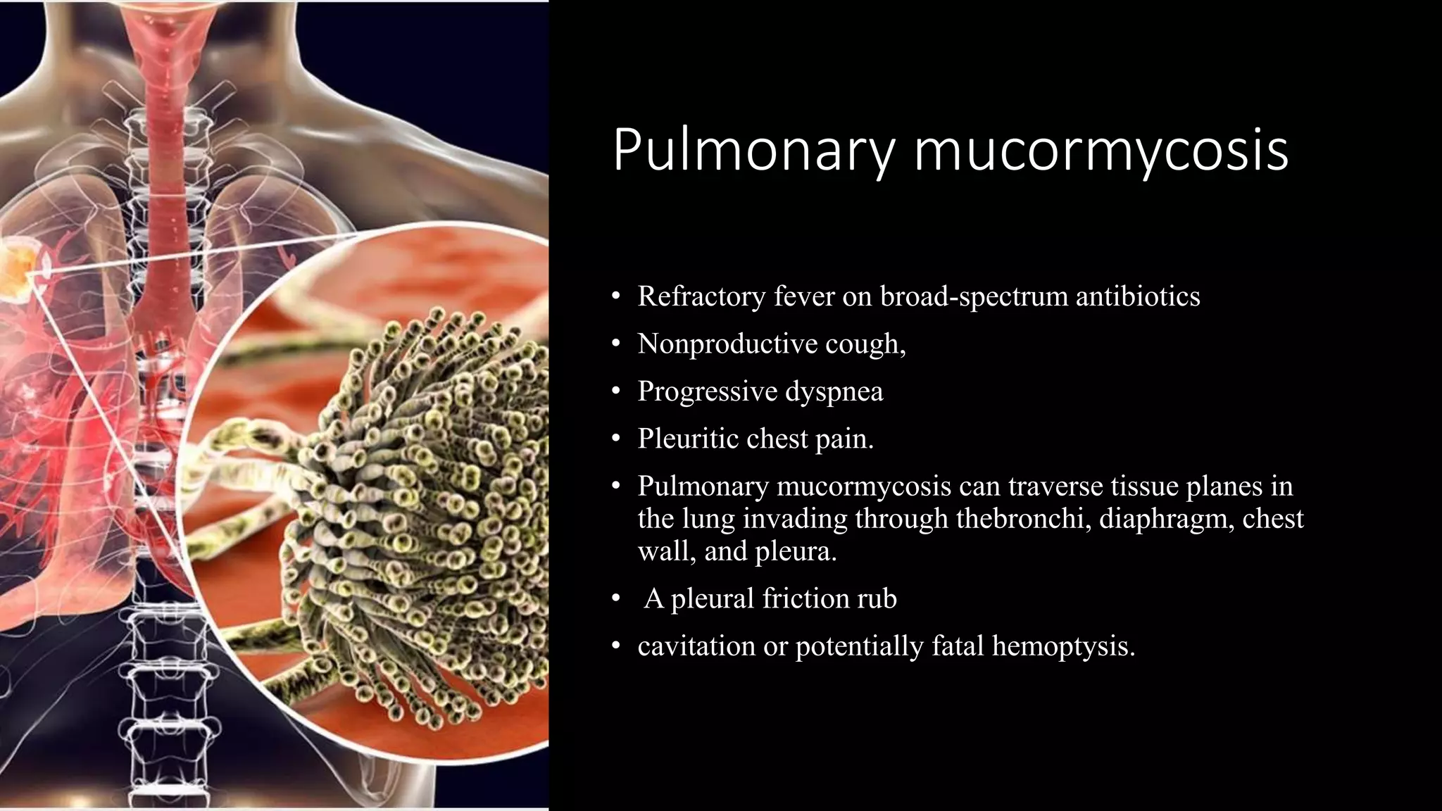 Mucormycosis and its management | PPTX
