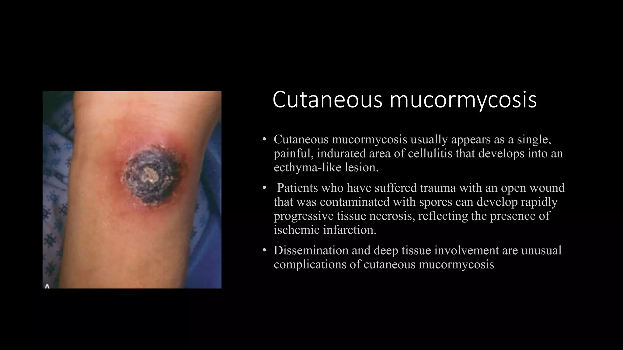 Mucormycosis and its management | PPTX | Ear, Nose and Throat ...