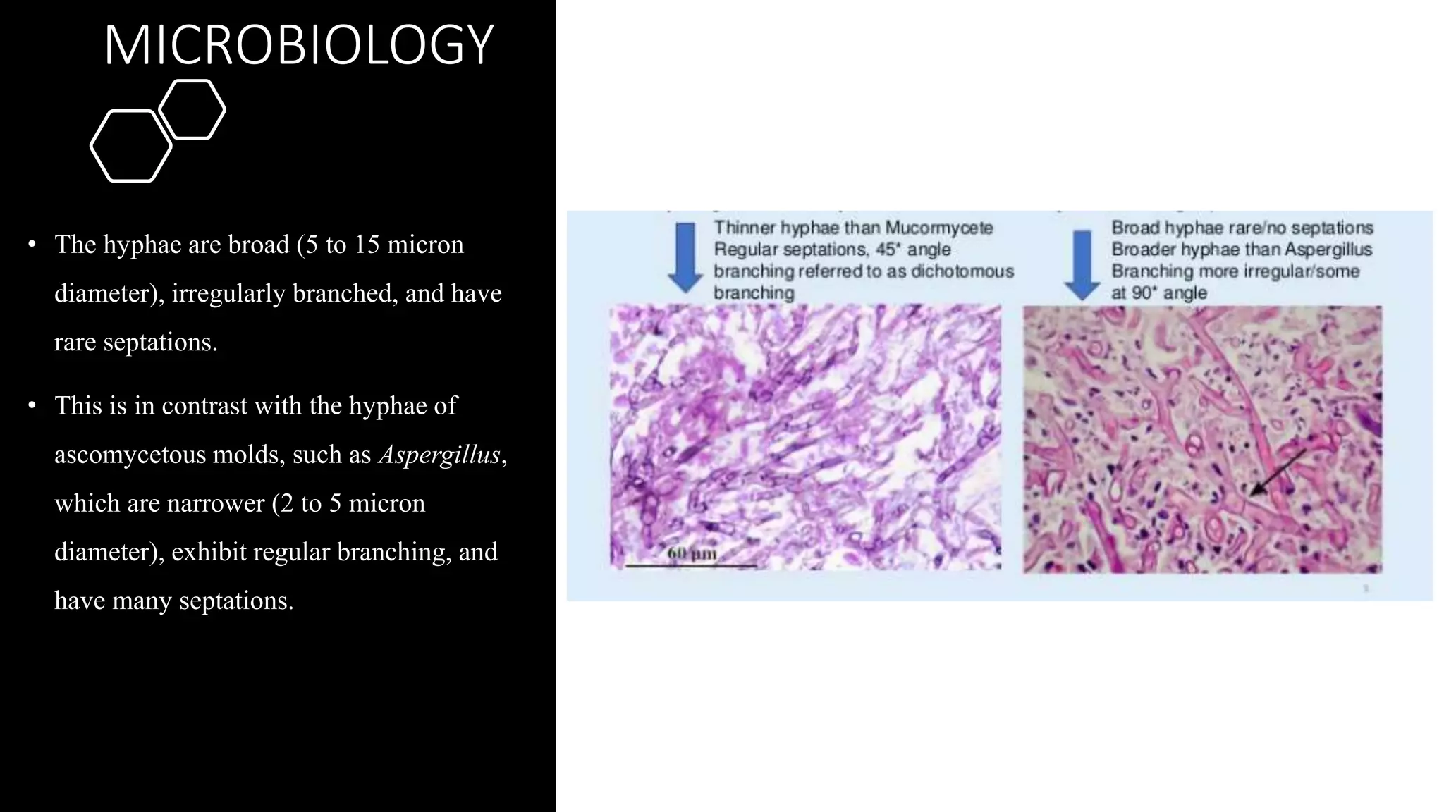 Mucormycosis and its management | PPTX