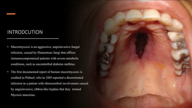 Mucormycosis and its management | PPTX | Ear, Nose and Throat ...