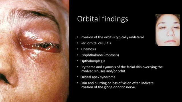 Mucormycosis and its management | PPTX | Ear, Nose and Throat ...