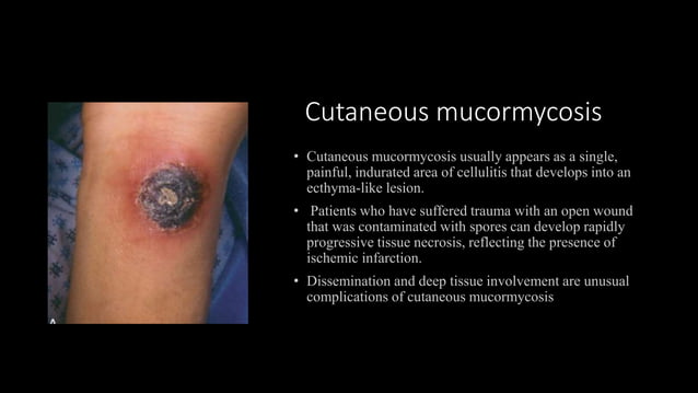 Mucormycosis and its management | PPTX | Ear, Nose and Throat ...
