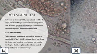 Mucormycosis and its management | PPTX