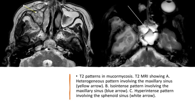 Mucormycosis and its management | PPTX | Ear, Nose and Throat ...