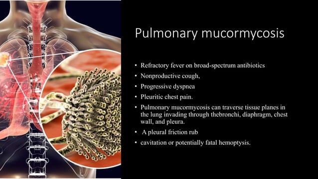Mucormycosis and its management