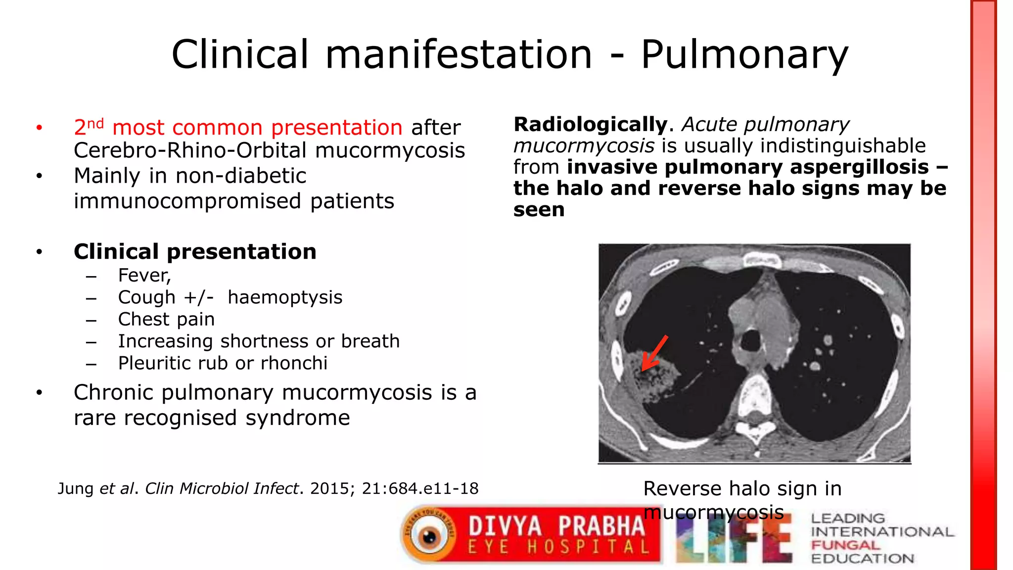 Mucormycosis & The Eye | PPT