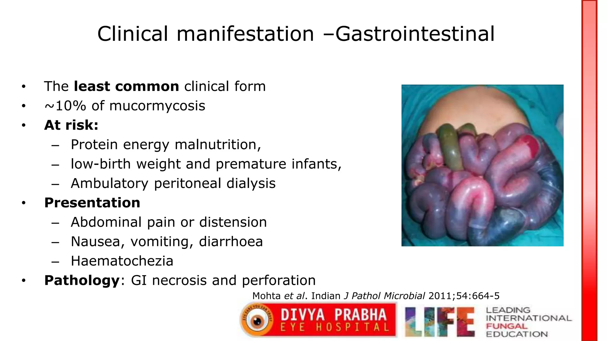 Mucormycosis & The Eye | PPT