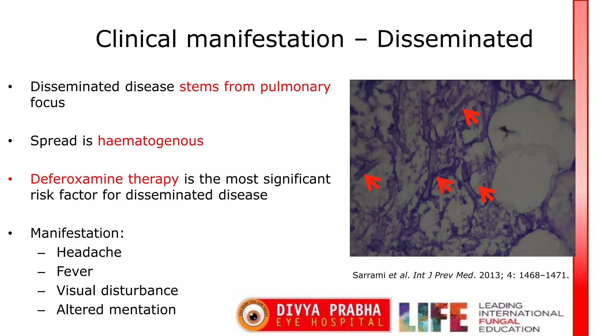 Mucormycosis & The Eye | PPT