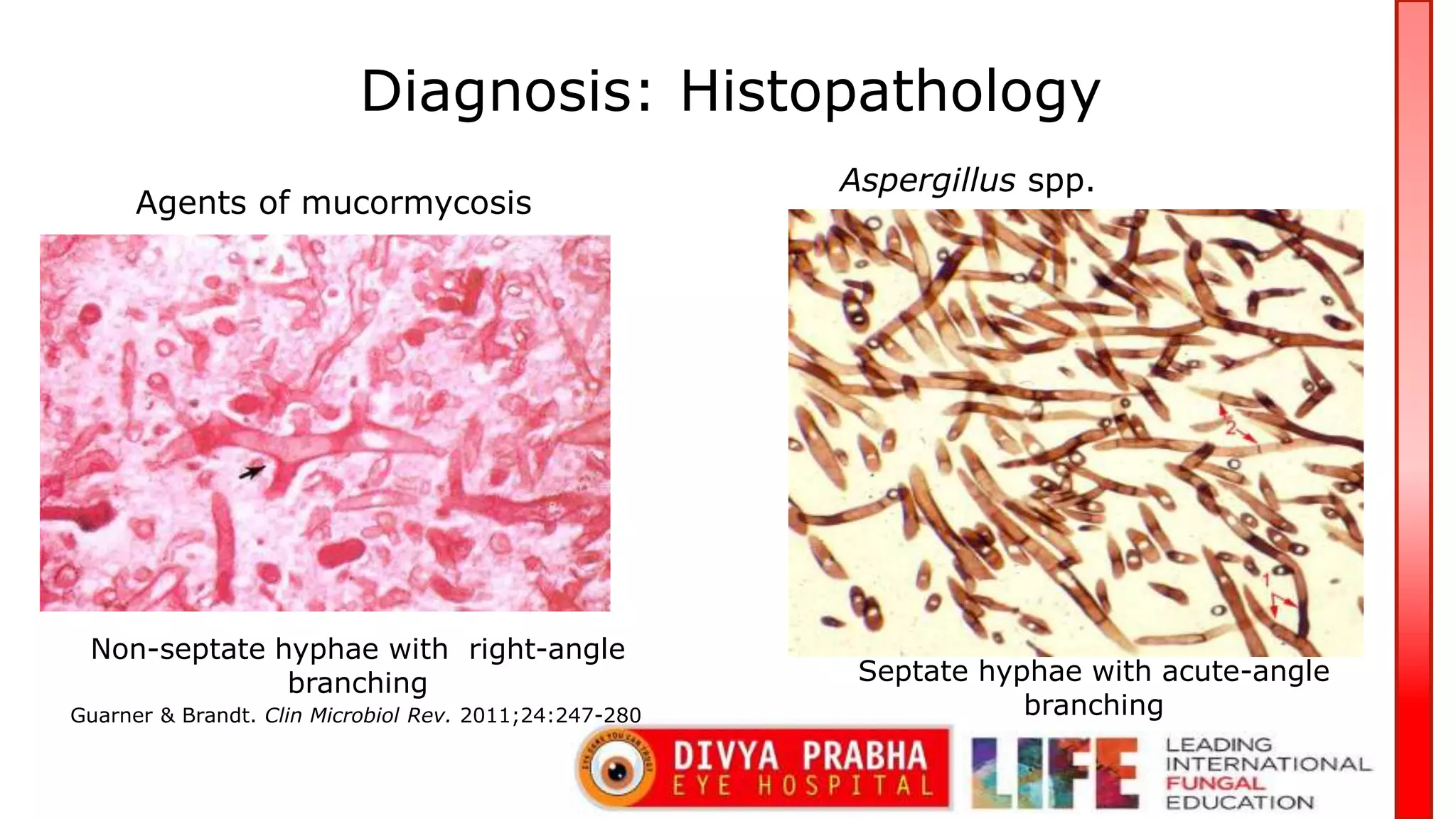 Mucormycosis & The Eye | PPT