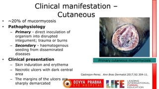 Mucormycosis & The Eye | PPT