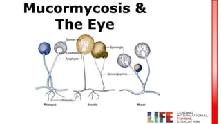 Mucormycosis & The Eye | PPT