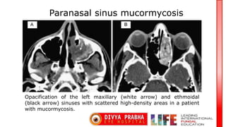 Mucormycosis & The Eye | PPT