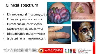 Mucormycosis & The Eye | PPT