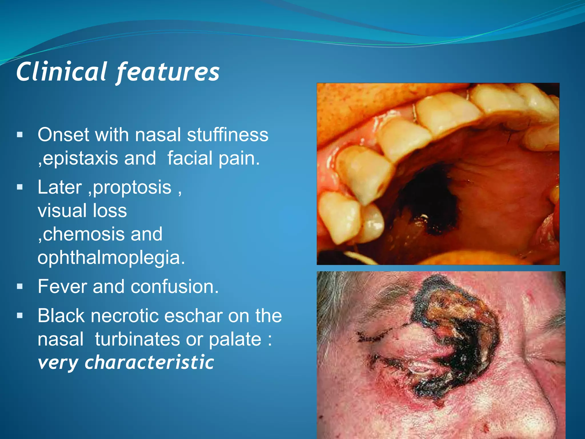 Mucormycosis ppt by Dr. Bomkar bam ENT M.S. | PPTX