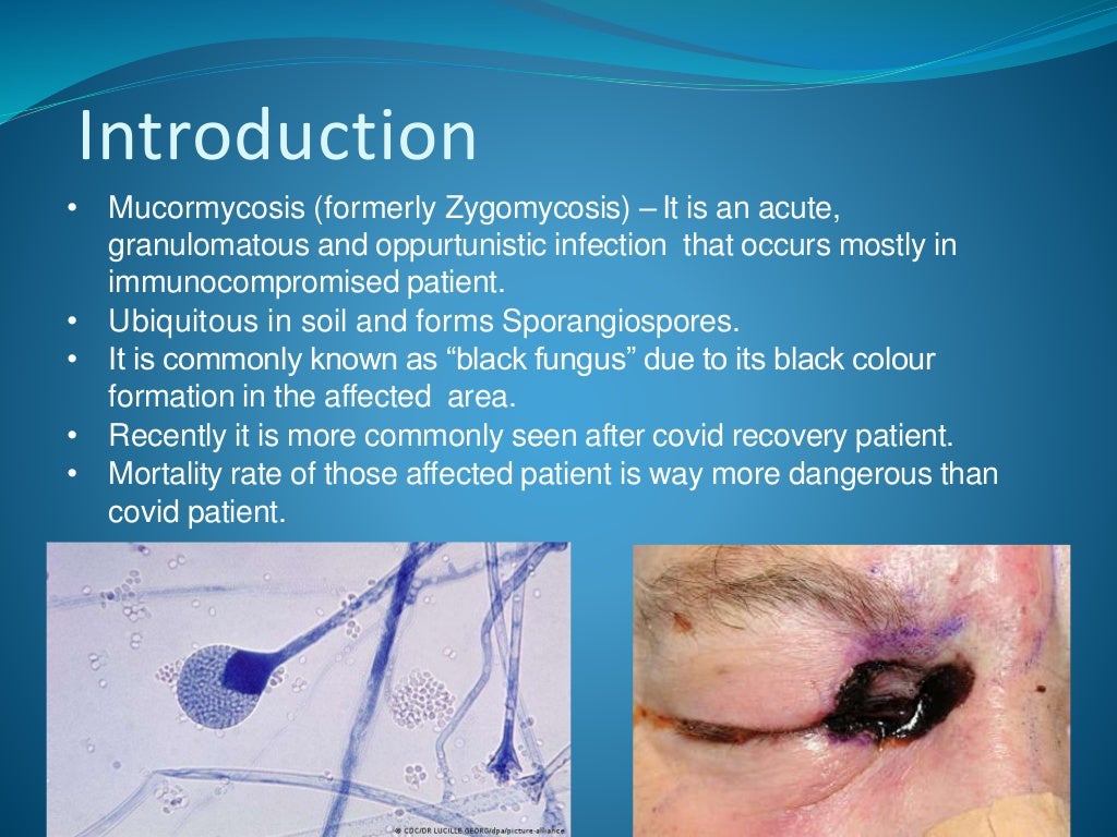Mucormycosis ppt by Dr. Bomkar bam ENT M.S.