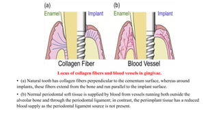 Mucosa- Implant Interface.pptx