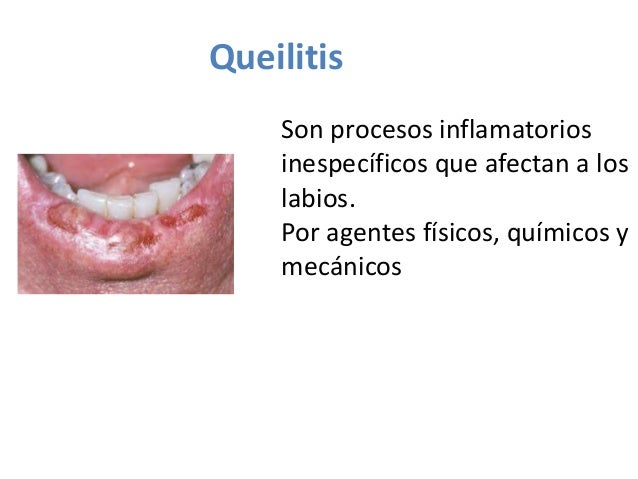 Mucosa oral